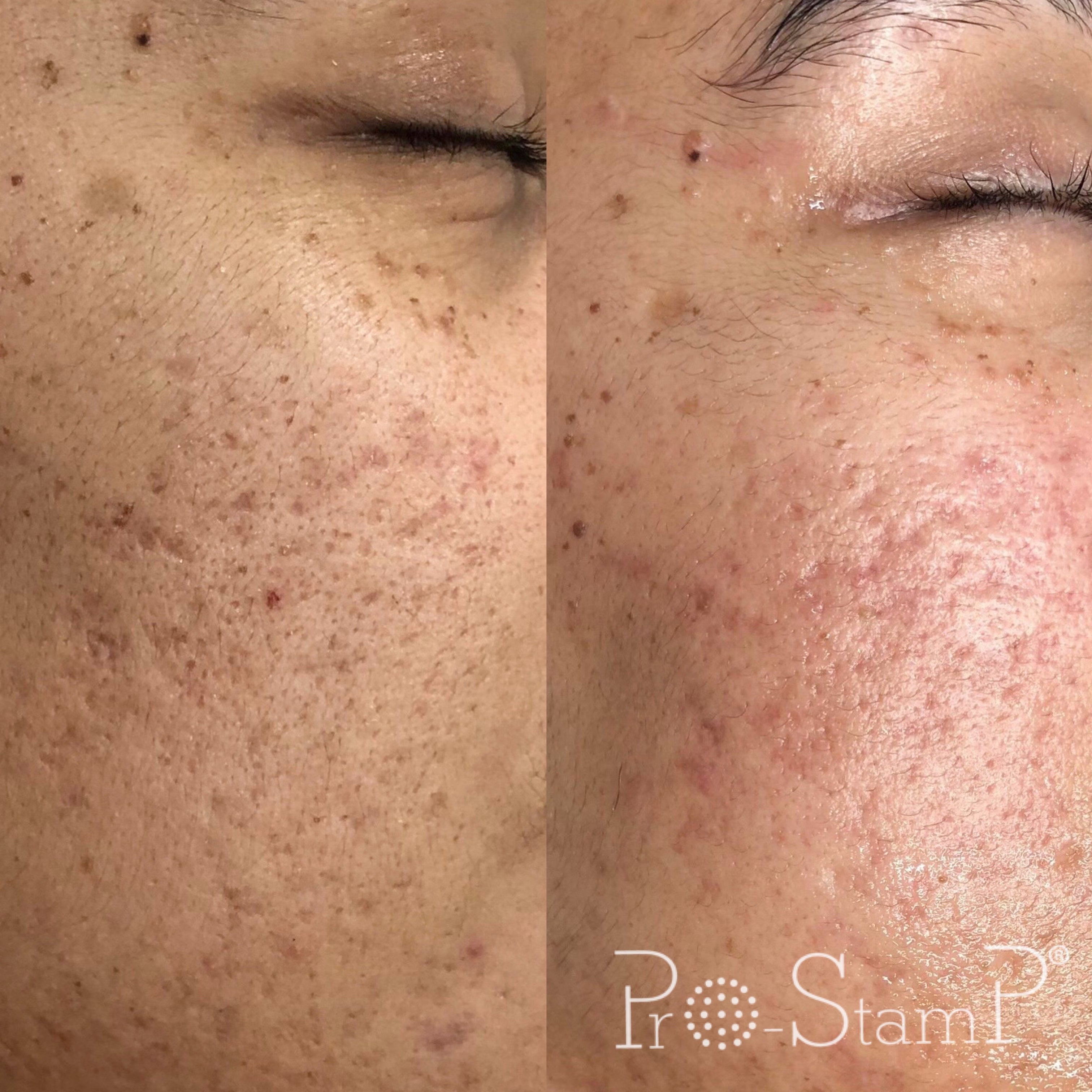 Results – Pro-Stamp®