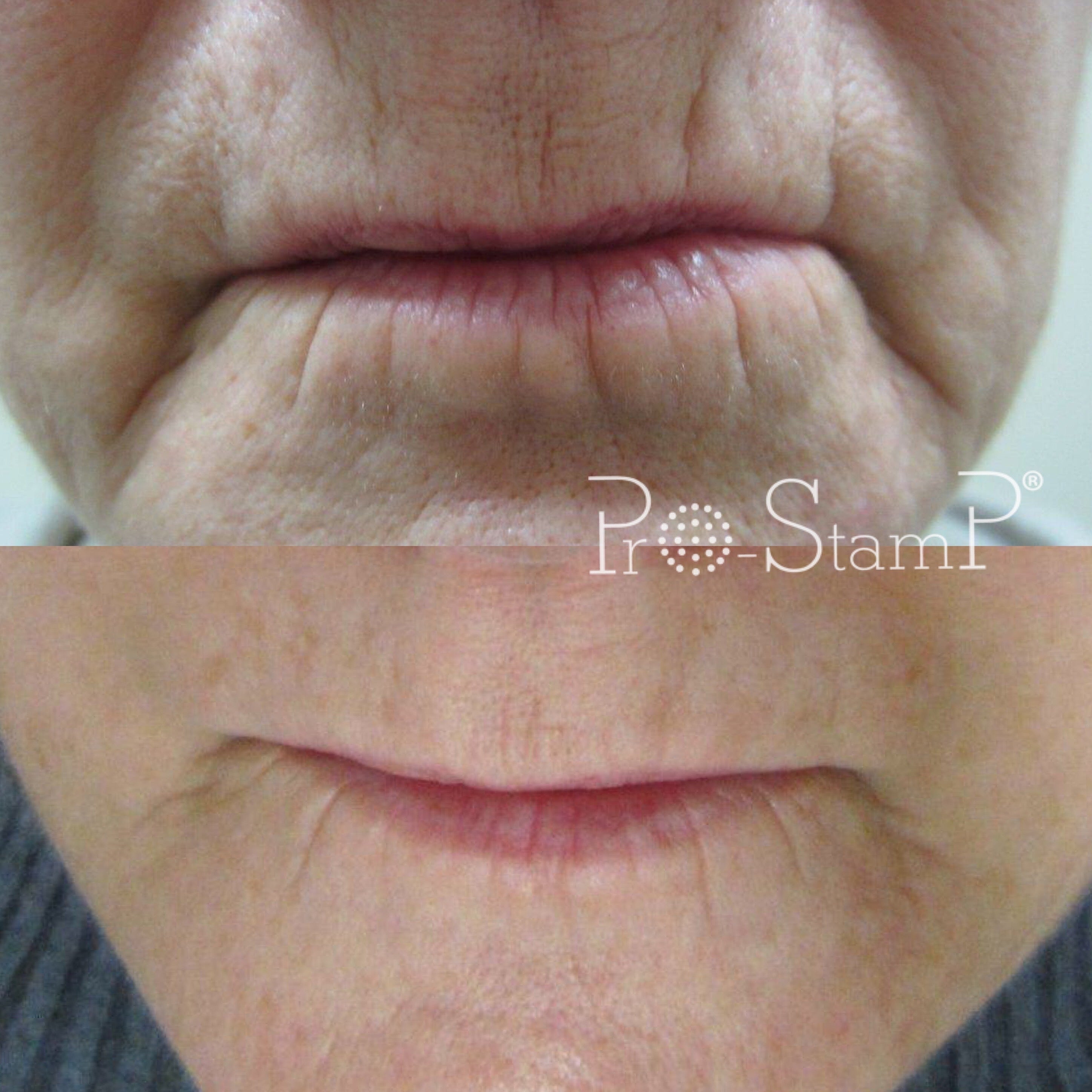 Results – Pro-Stamp®