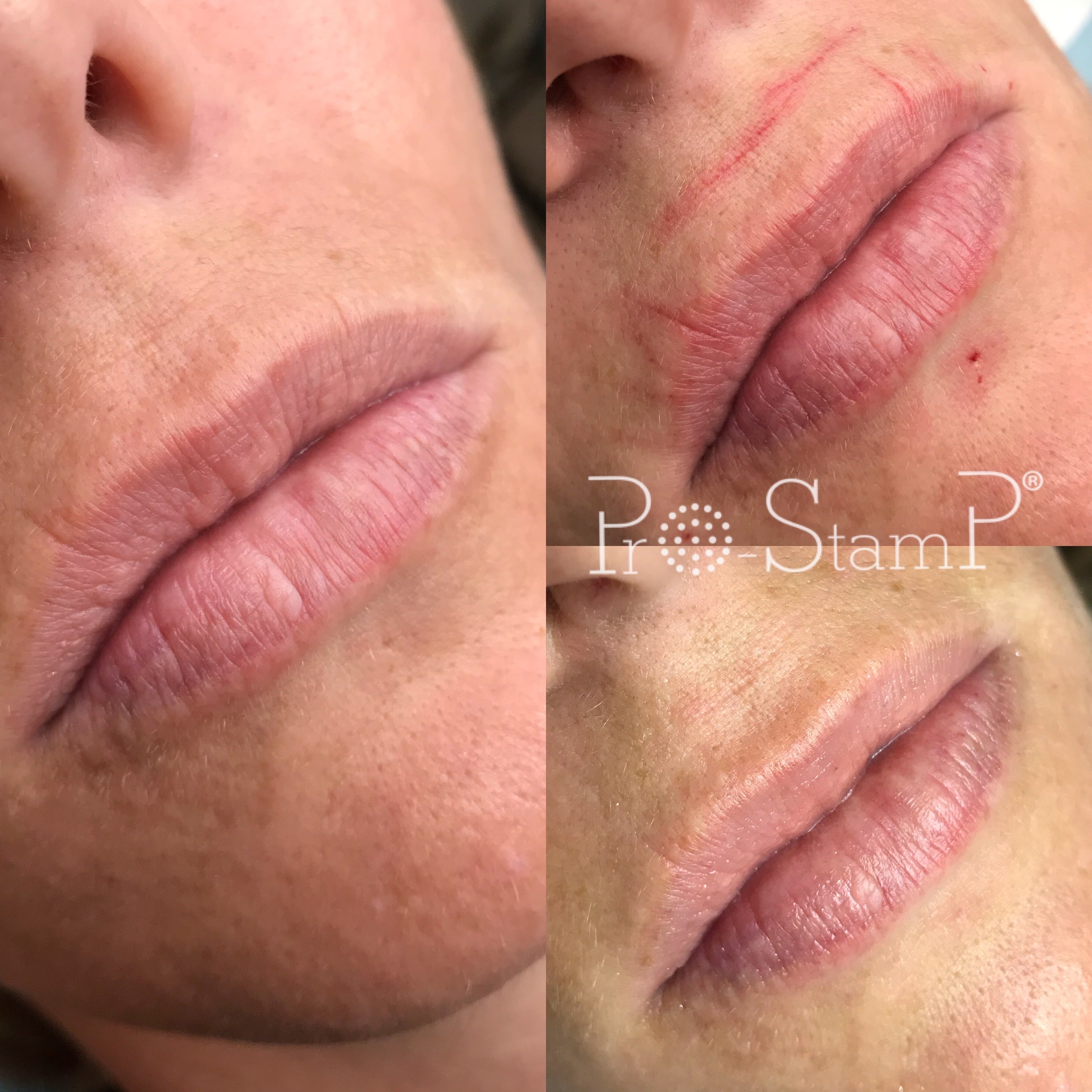 Results – Pro-Stamp®